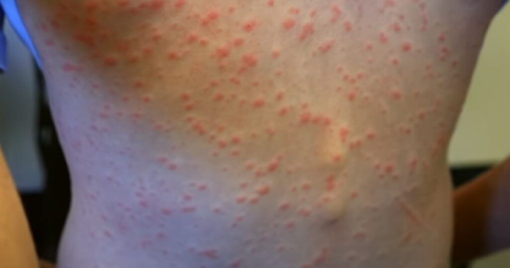 BREAKING: Eerste geval van de apenpokken in Nederland