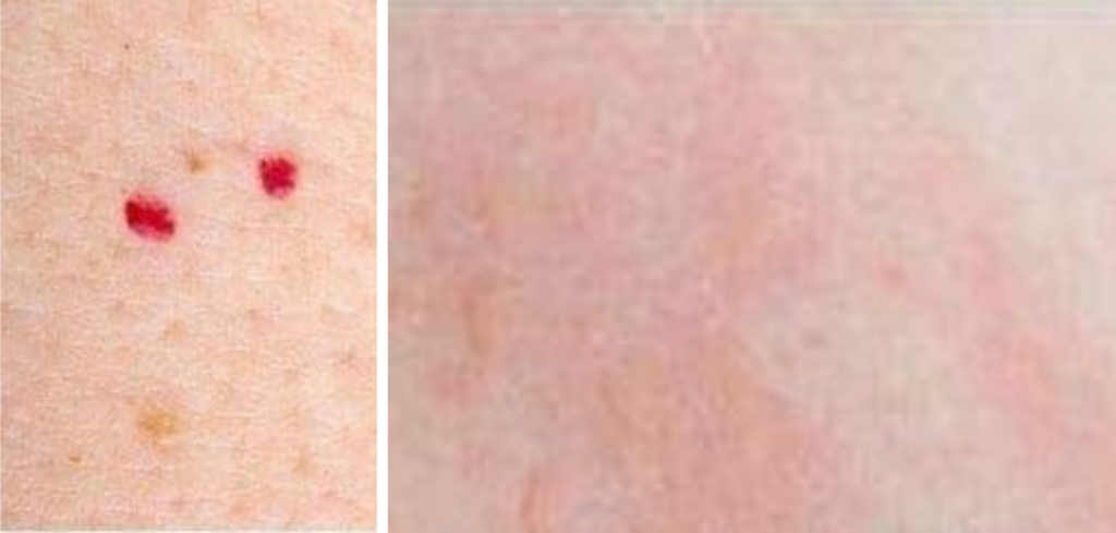 Let op: Als je deze rode stippen op je huid ziet, is het belangrijk om ...